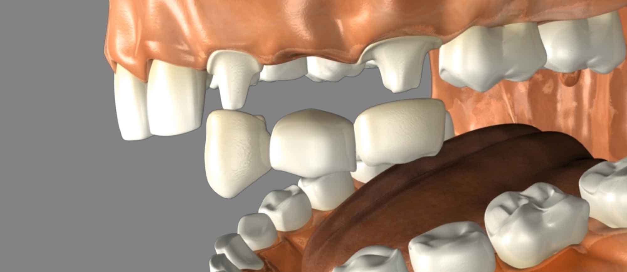 Replace Missing Teeth | Glendale Dental Arts